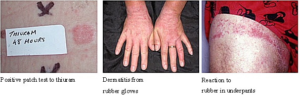 Skin Allergy Research at Wear Earrings Again with Maggie's Creations ...